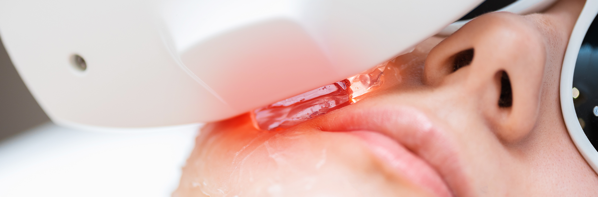 Laser Resurfacing For Acne Scars: Guide to Flawless Skin
